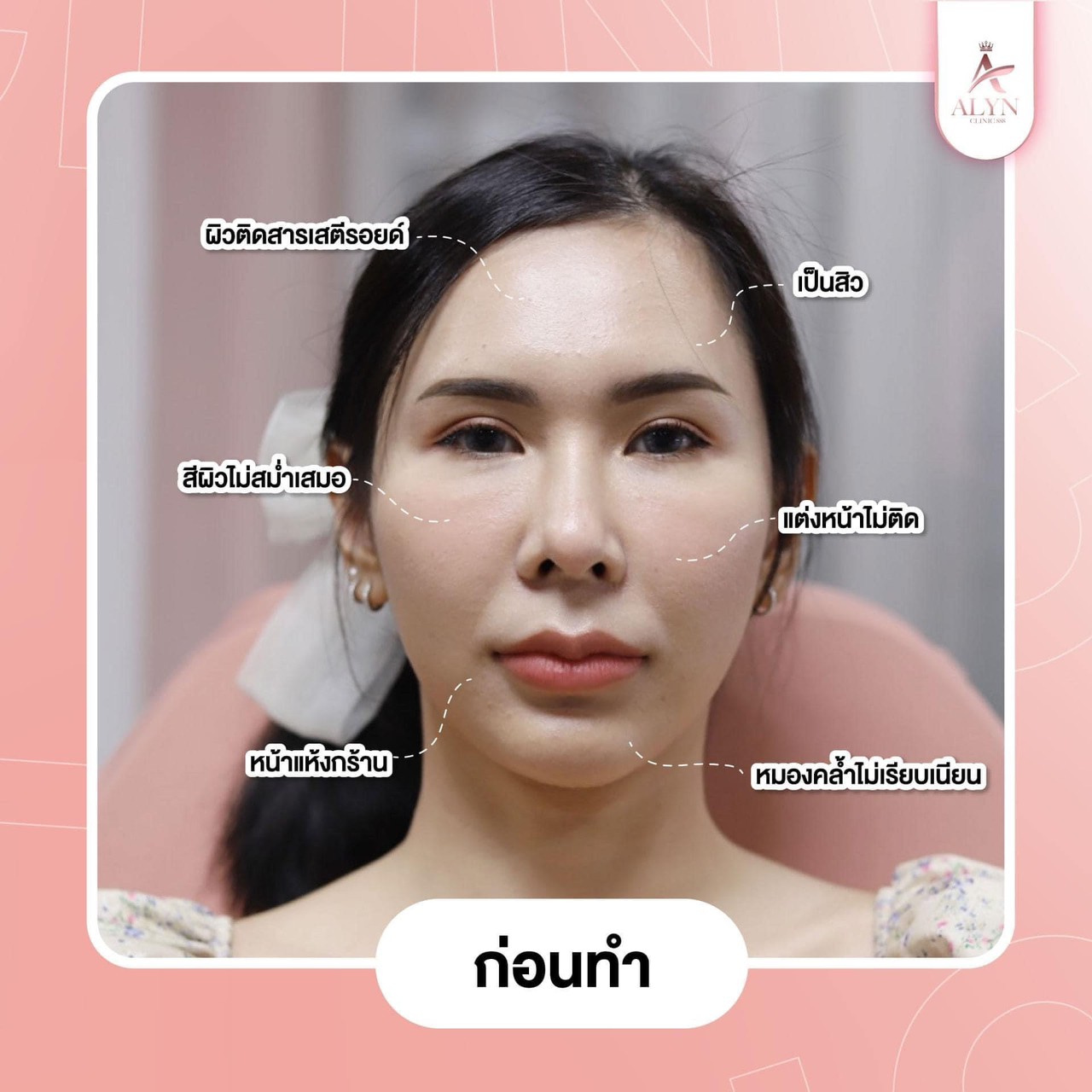 Tensonez 16 จุด หน้าใส ฉ่ำวาว - Alyn Clinic
